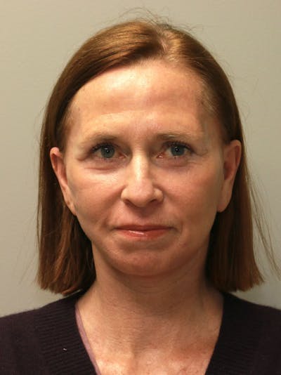 Facelift Before & After Photos | Hessler Plastic Surgery