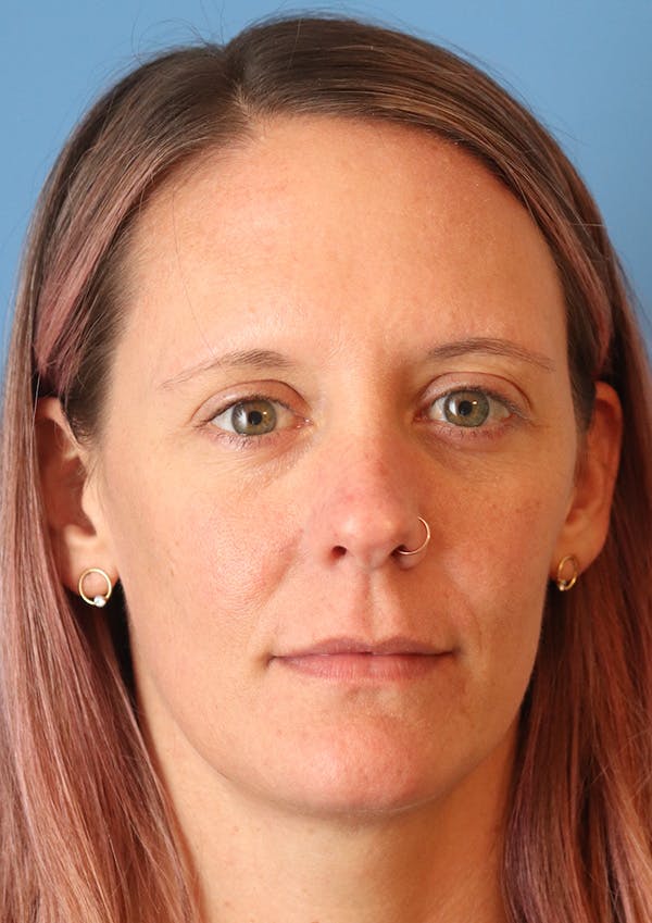 Patient 145843865 | Cheek & Under Eye Filler Before & After Photos | Dr ...