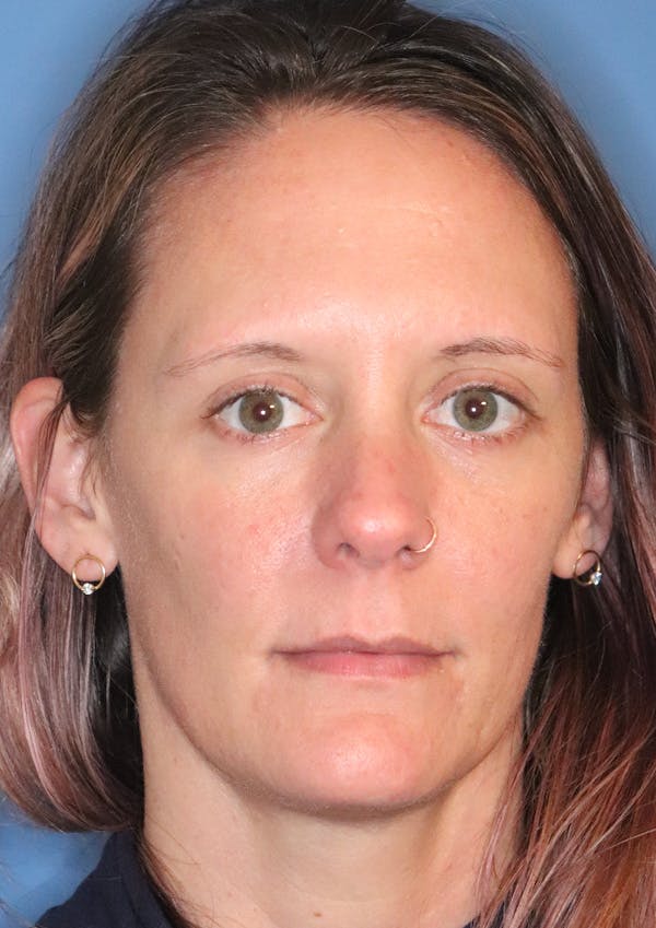 Patient 145843865 | Cheek & Under Eye Filler Before & After Photos | Dr ...