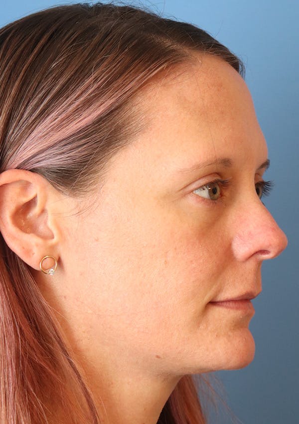 Patient 145843865 | Cheek & Under Eye Filler Before & After Photos | Dr ...