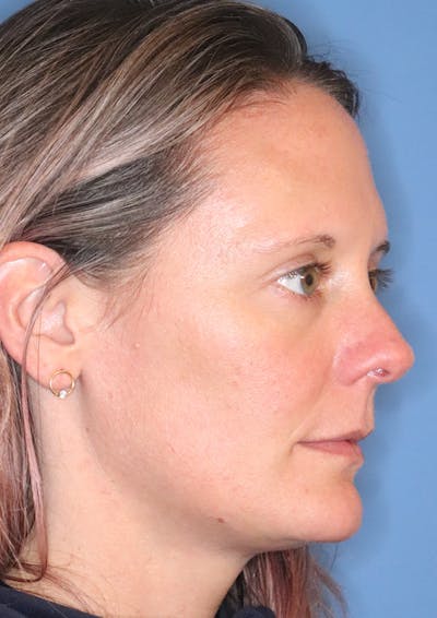 Patient 145843865 | Cheek & Under Eye Filler Before & After Photos | Dr ...