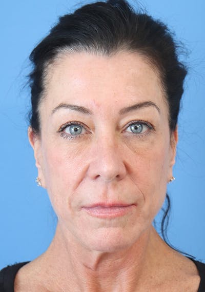 Cheek And Under Eye Filler Before And After Photos Dr Victoria Givens