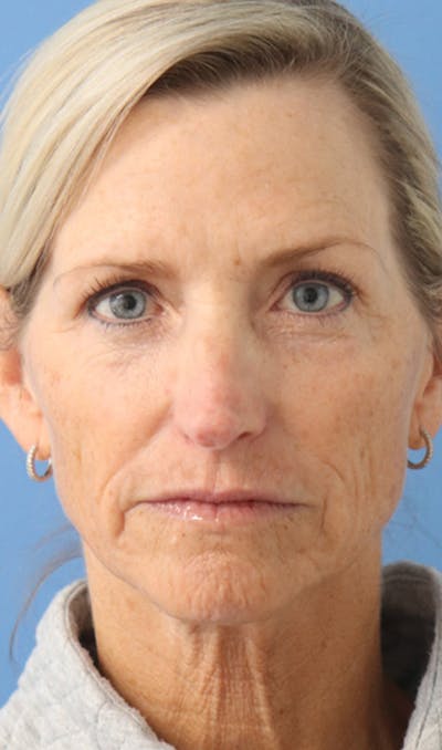Cheek And Under Eye Filler Before And After Photos Dr Victoria Givens