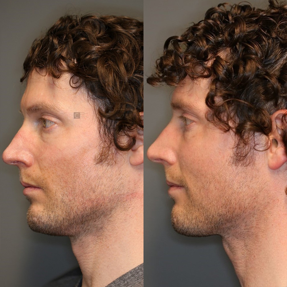 Chiseled Jaw Before And After
