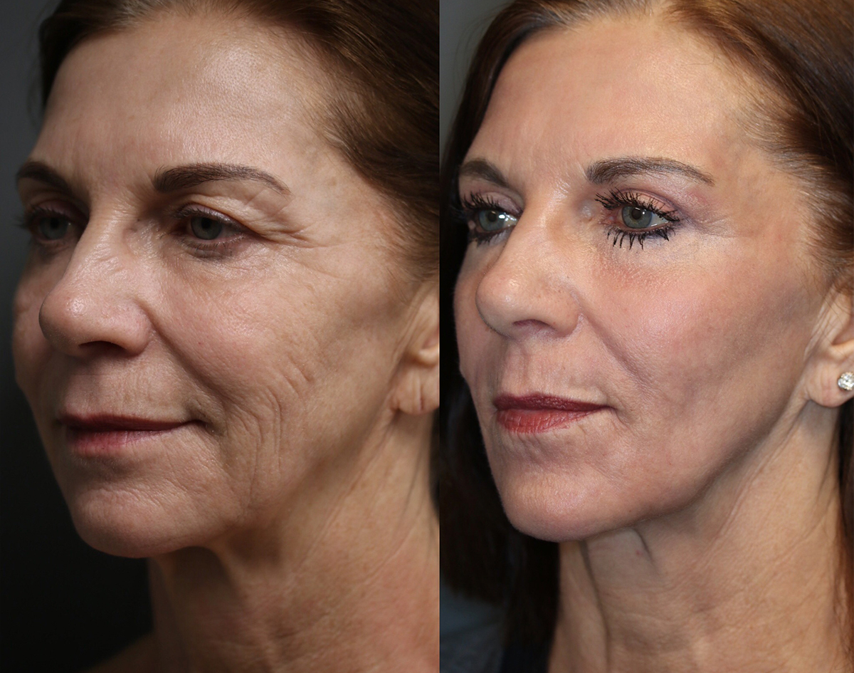 Eyebrow Threading Before And After