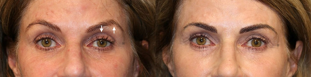 Upper Blepharoplasty Gone Wrong