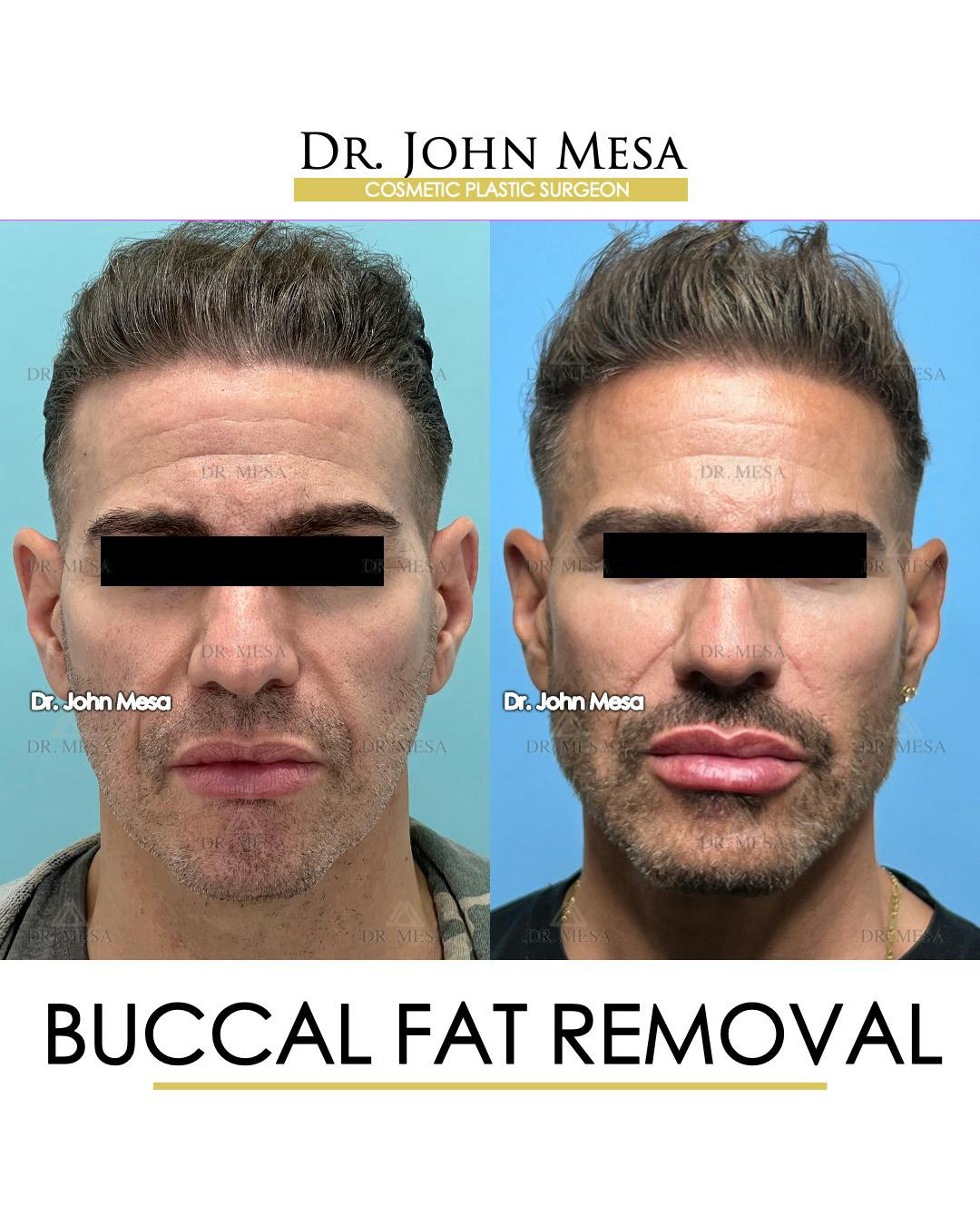 Men's Buccal Fat Pad Removal Gallery