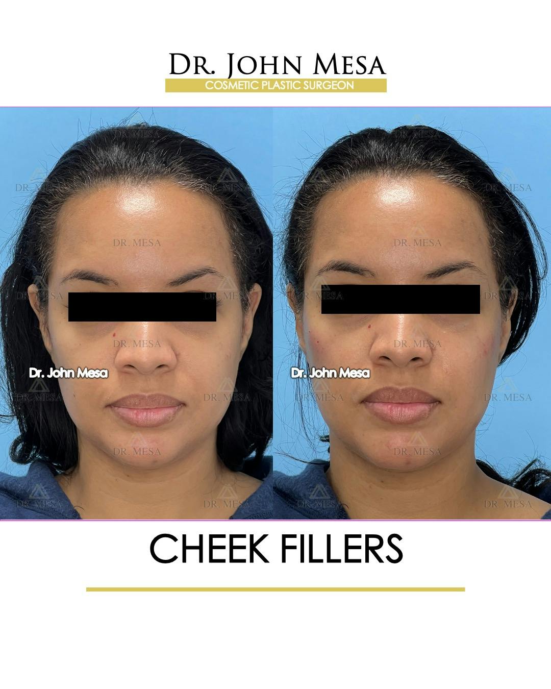 Cheekbone Filler Before & After Photos | Dr. Mesa