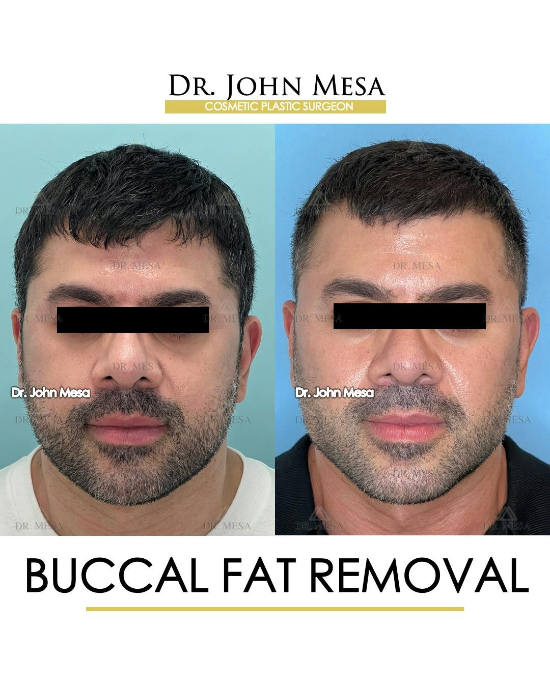 Buccal Fat Pad Removal for Men Before & After Photos | Dr. Mesa