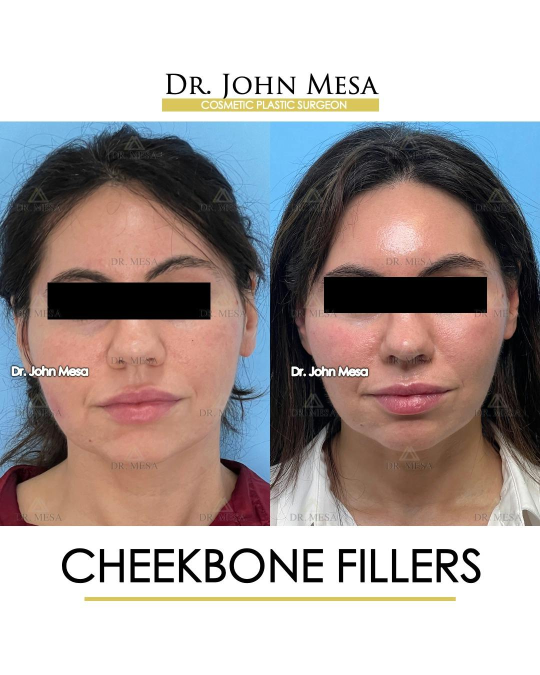 Cheekbone Filler Before & After Photos | Dr. Mesa