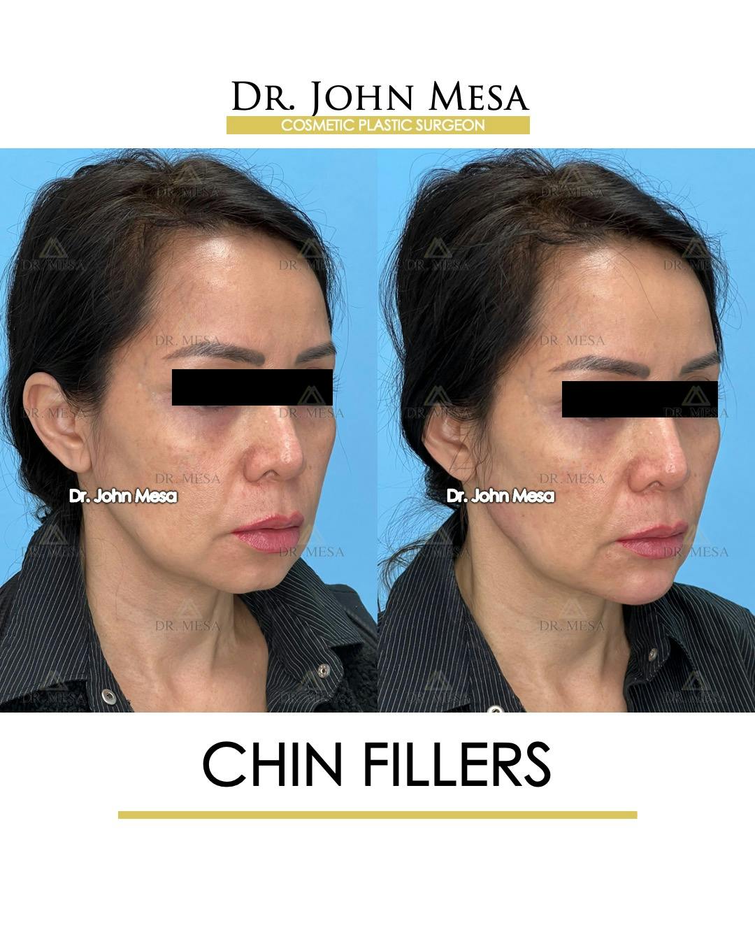 Chin Filler Before & After Photos | Dr. Mesa