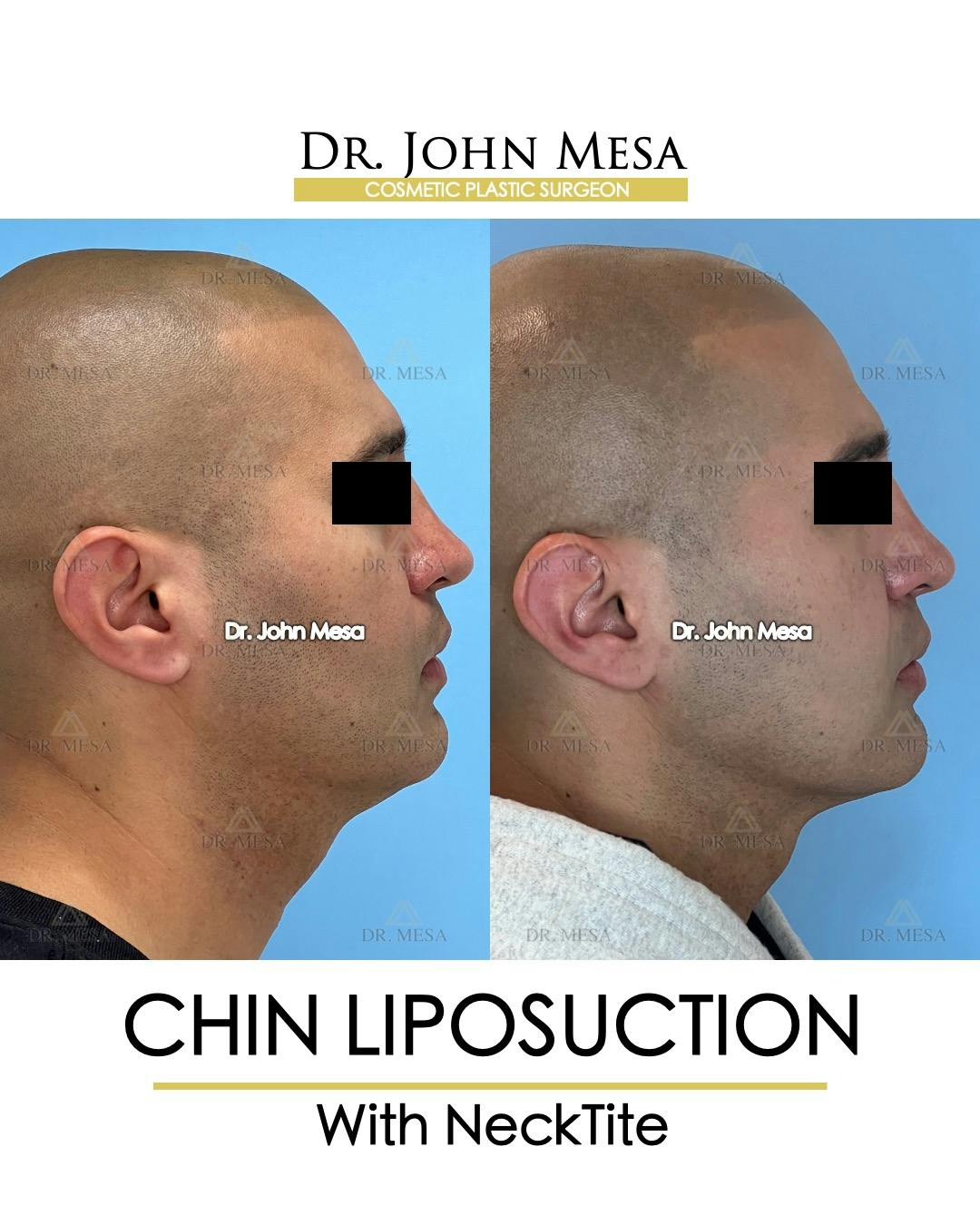 Chin Liposuction for Men Before & After Photos | Dr. Mesa