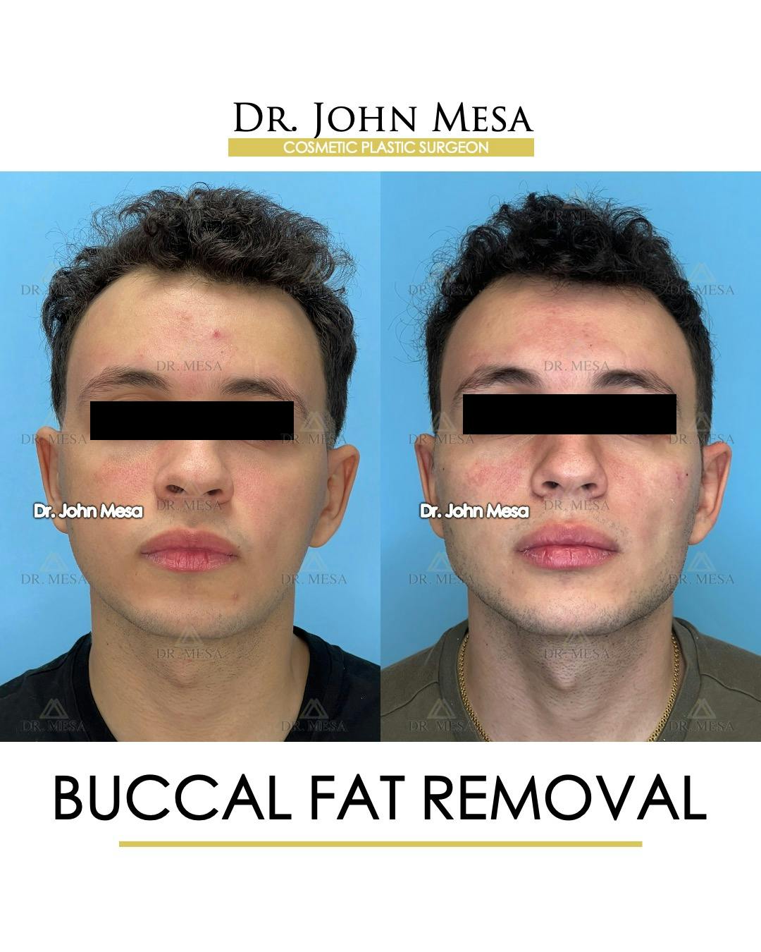 Buccal Fat Pad Removal for Men Before & After Photos | Dr. Mesa