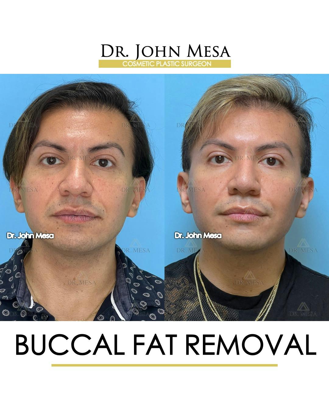Buccal Fat Pad Removal for Men Before & After Photos | Dr. Mesa