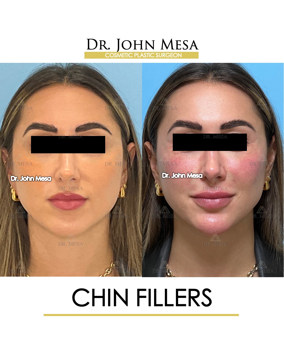 Chin Fillers Before And After
