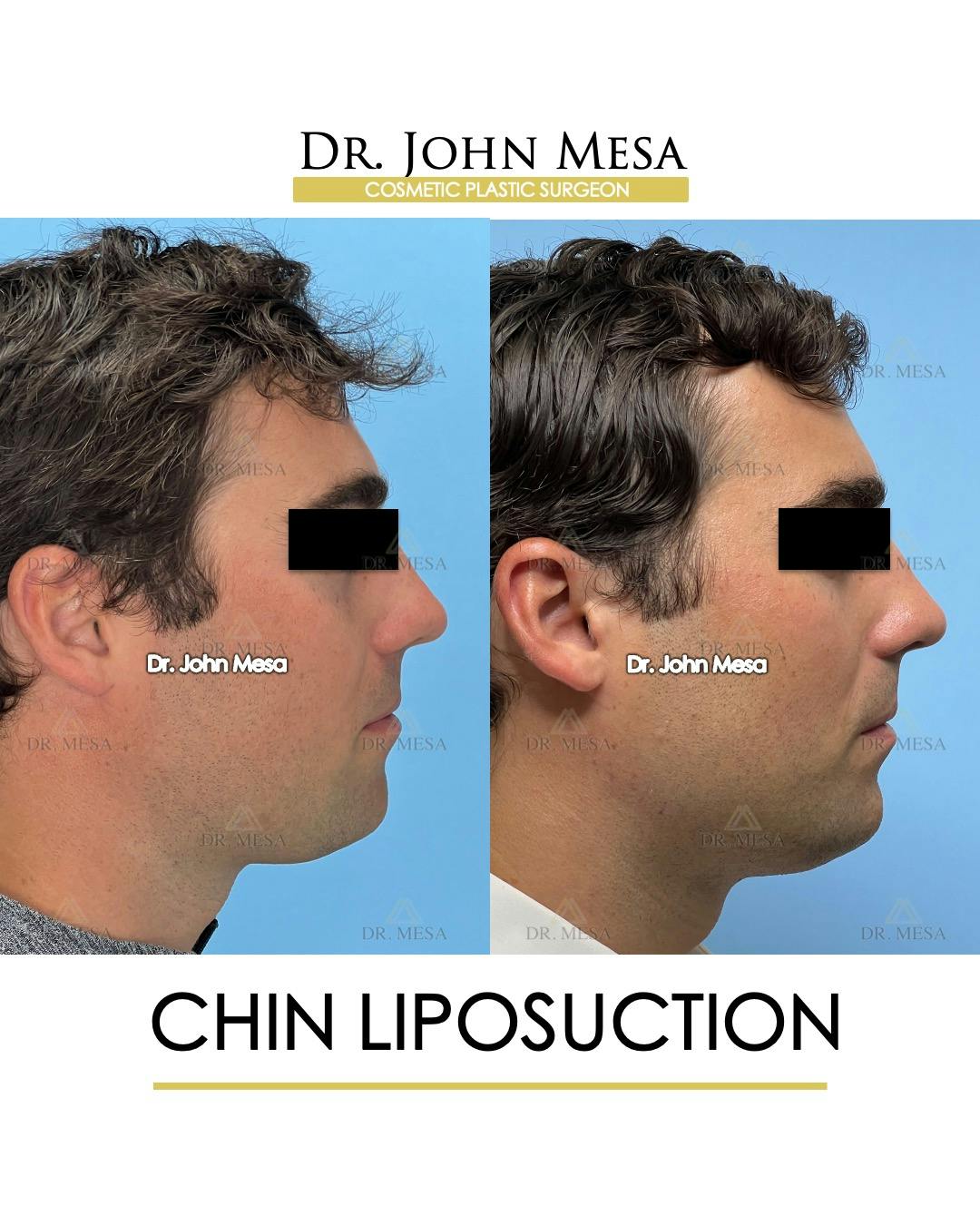Chin Liposuction for Men Before & After Photos | Dr. Mesa