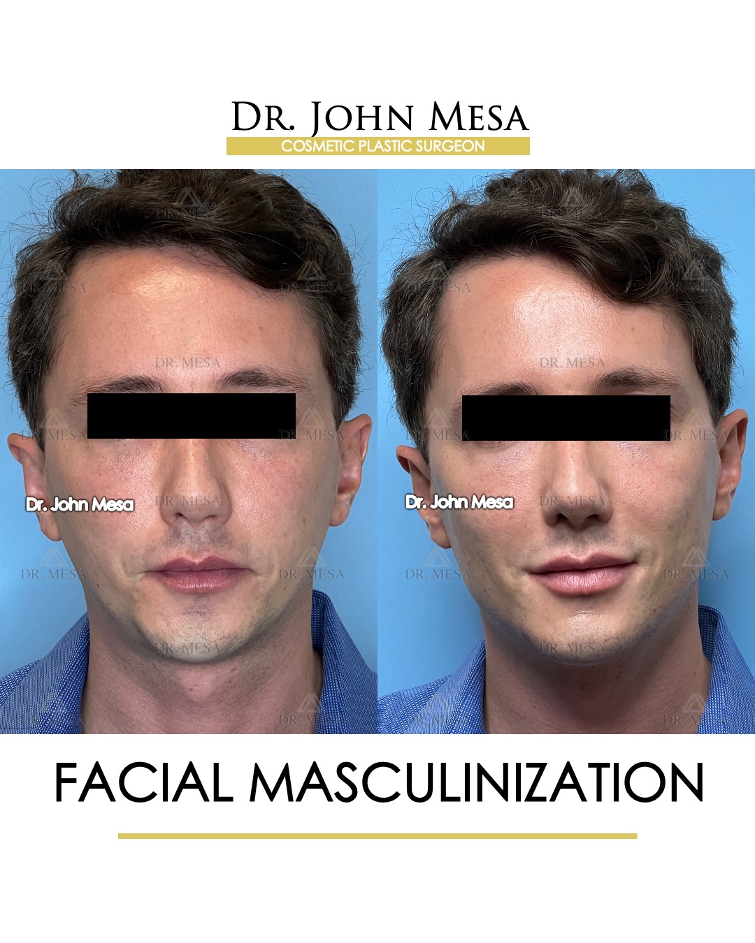Men Facial Before And After