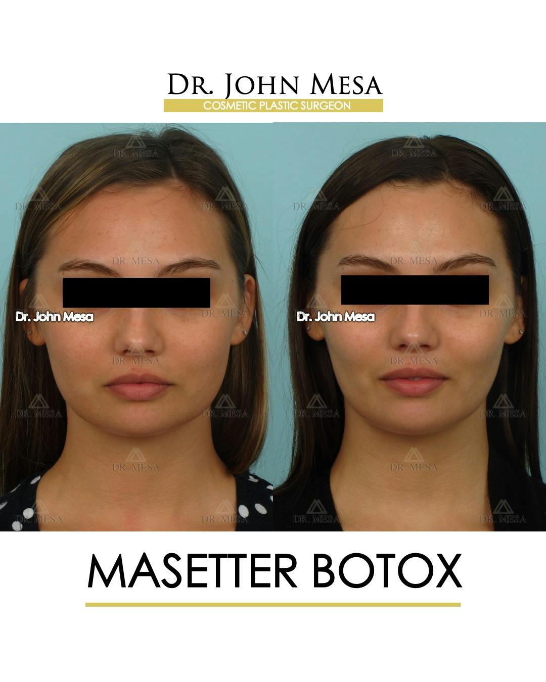BOTOX Before & After Photos | Dr. Mesa