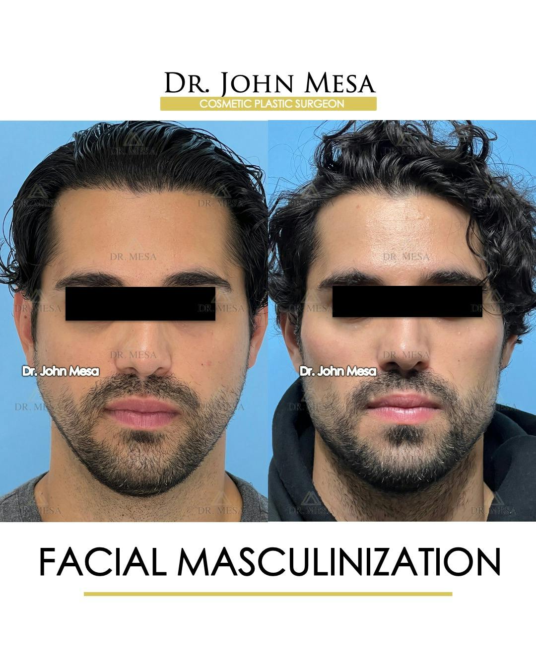 Facial Masculinization Before & After Photos | Dr. Mesa