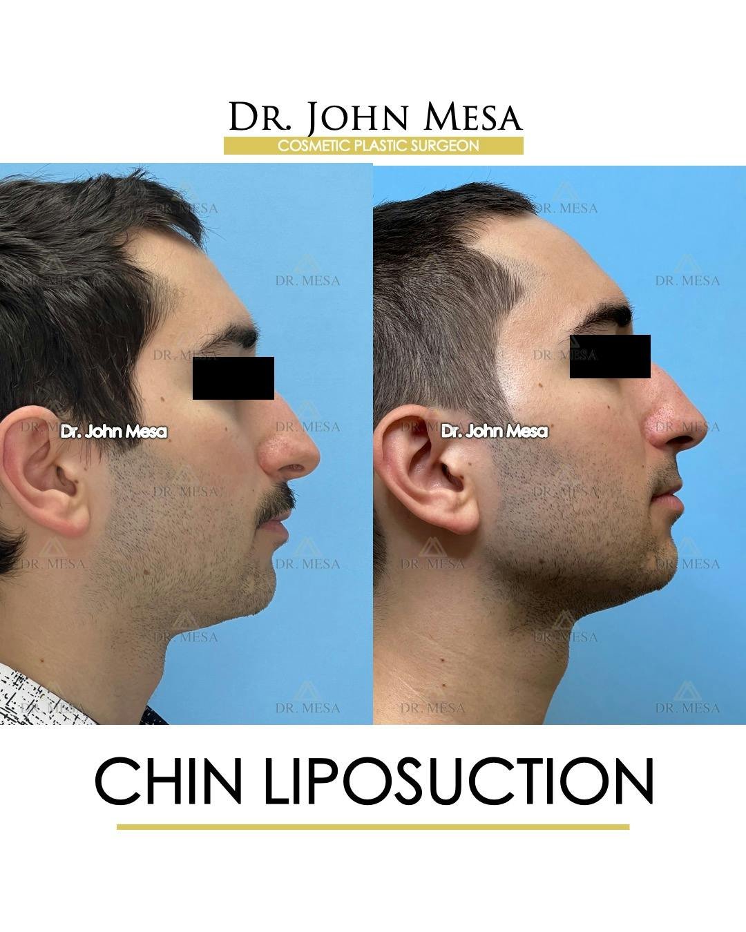 Chin Liposuction for Men Before & After Photos | Dr. Mesa