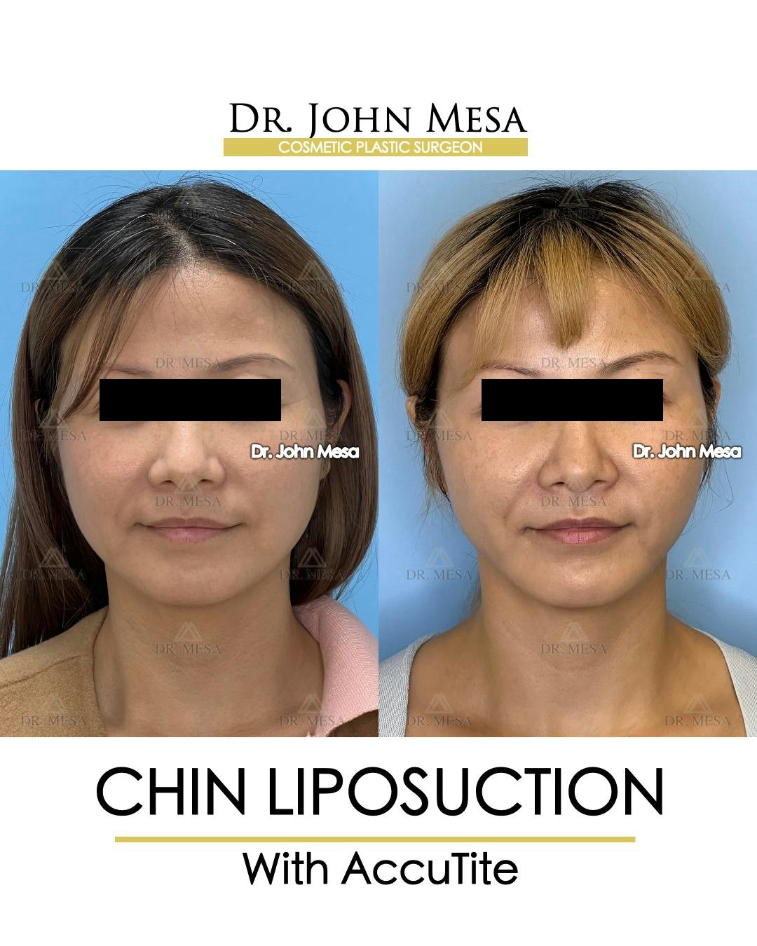 Chin Liposuction Before & After Photos | Dr. Mesa