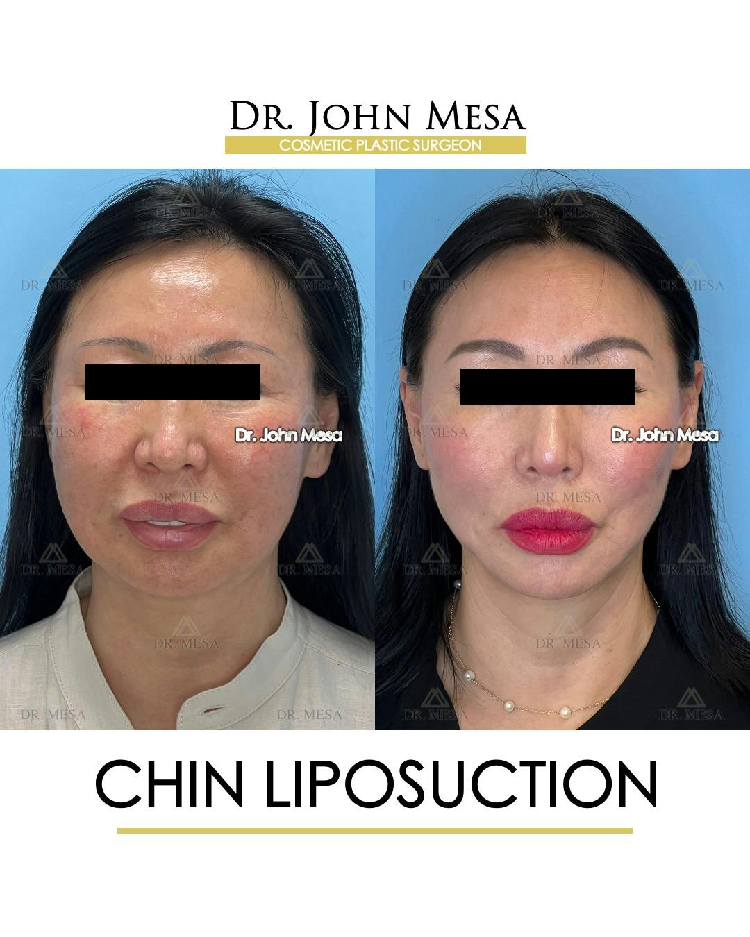 Chin Liposuction Before & After Photos | Dr. Mesa