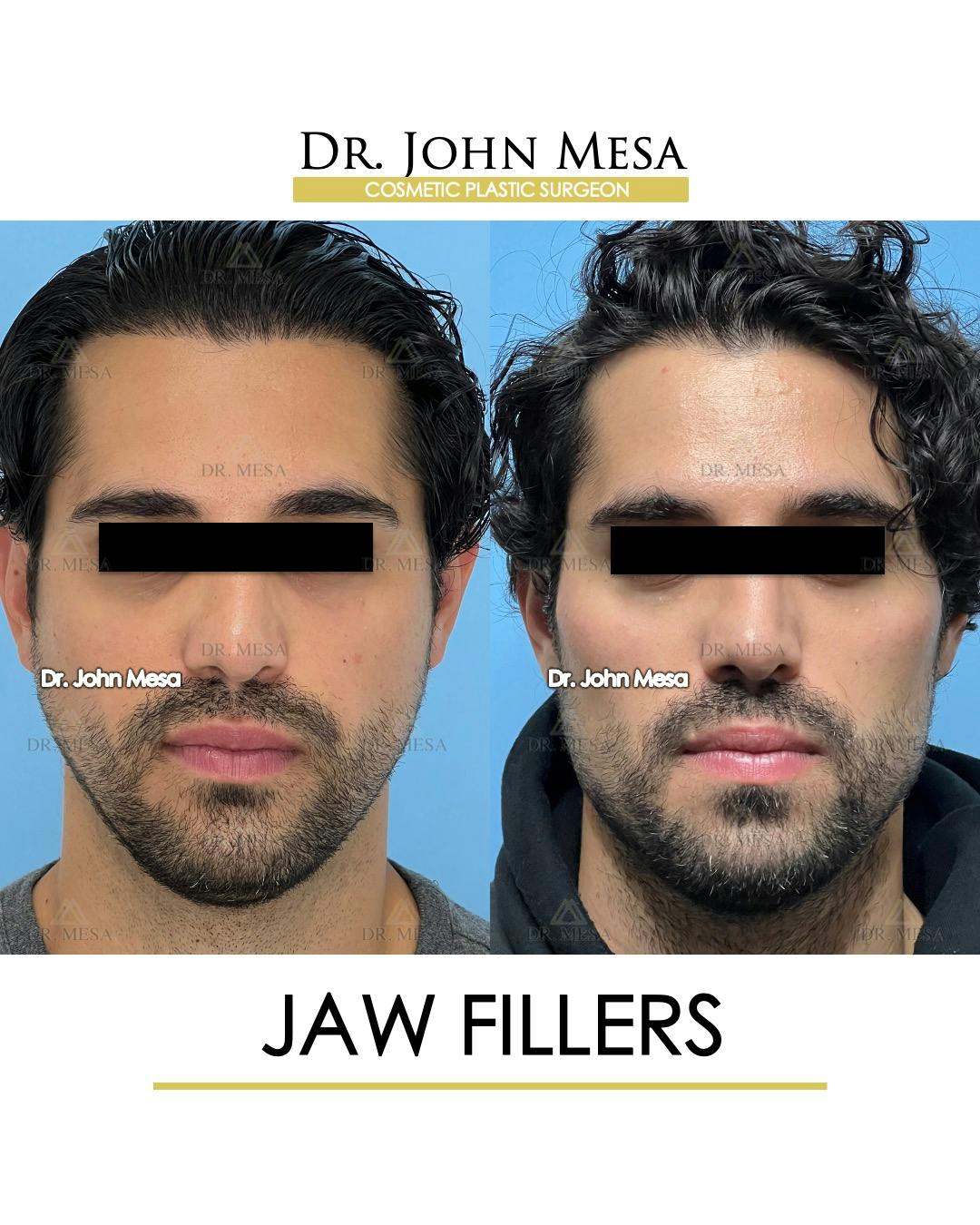 Jaw Filler for Men Before & After Photos | Dr. Mesa