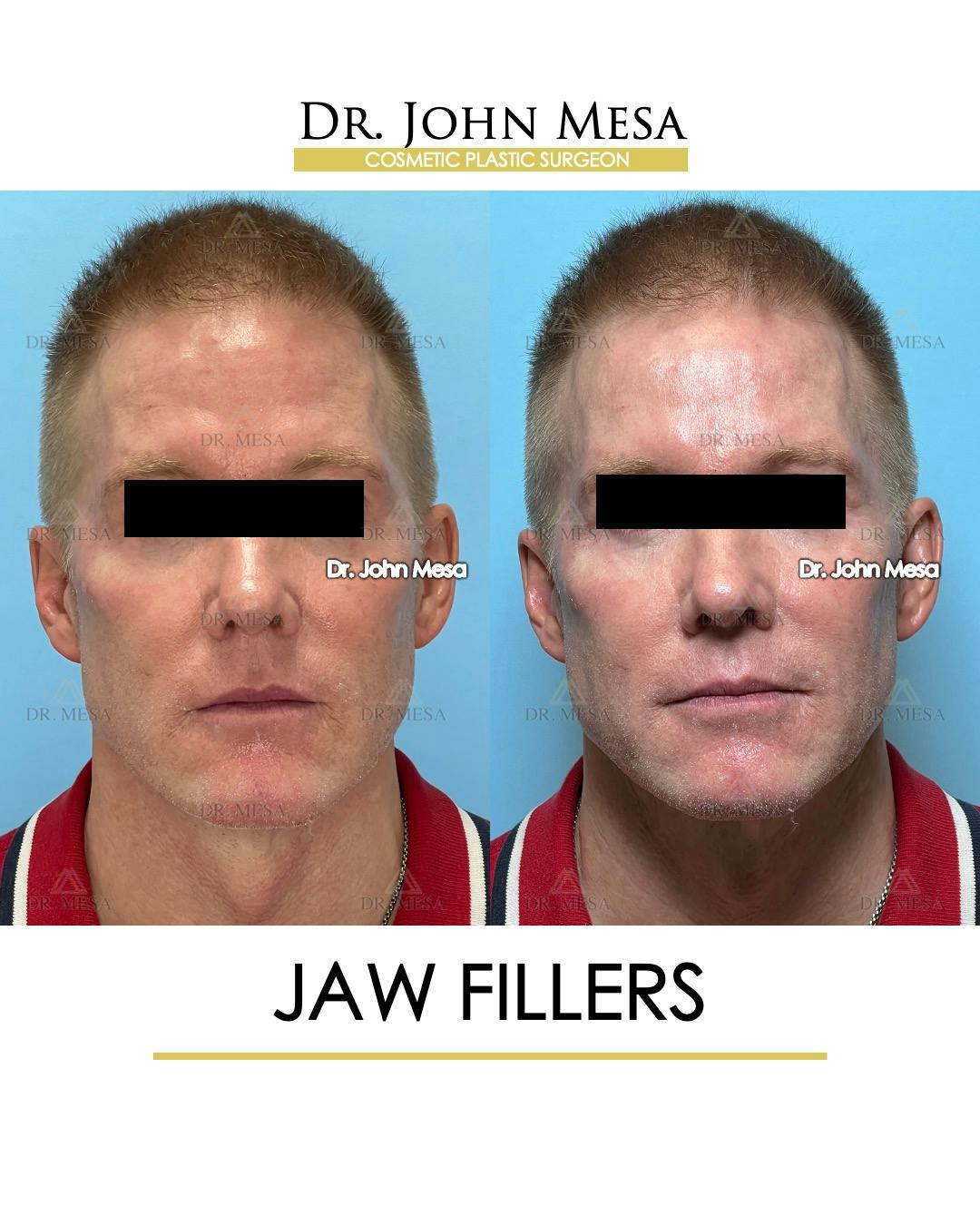 Jaw Filler for Men Before & After Photos | Dr. Mesa