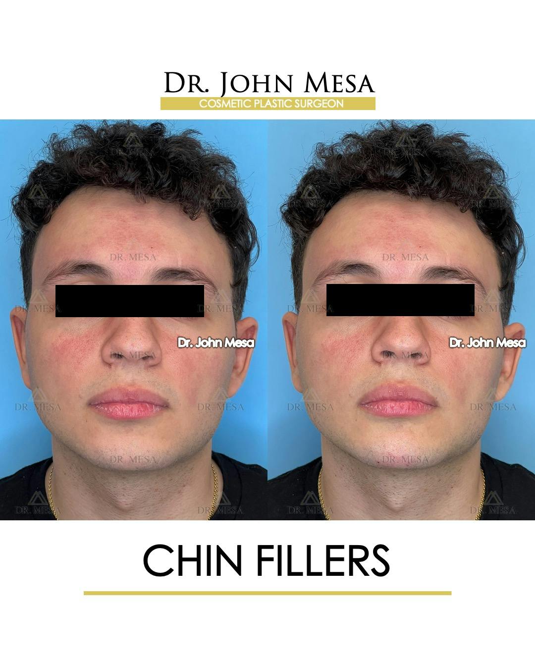 Chin Filler for Men Before & After Photos | Dr. Mesa