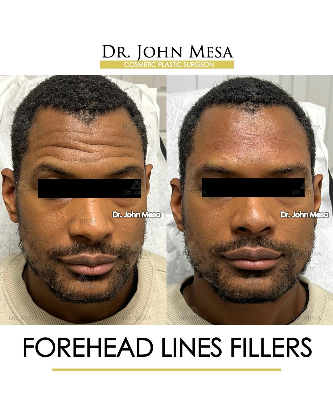 Forehead Lines Filler Before & After Photos | Dr. Mesa