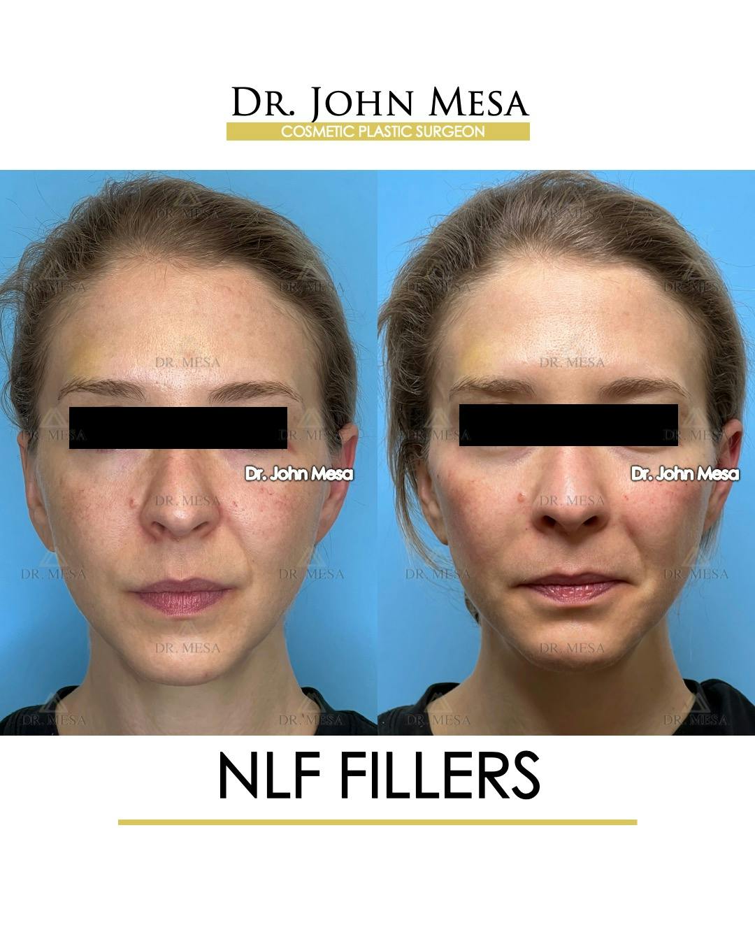 NLF Fillers Before & After Photos | Dr. Mesa