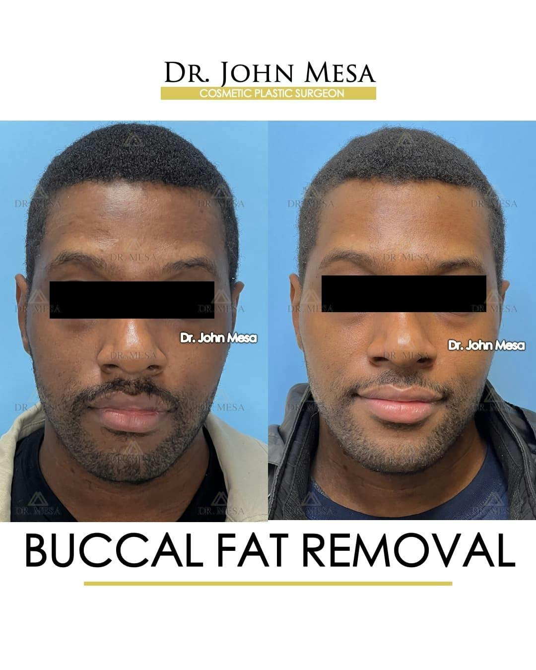 Buccal Fat Pad Removal for Men Before & After Photos | Dr. Mesa