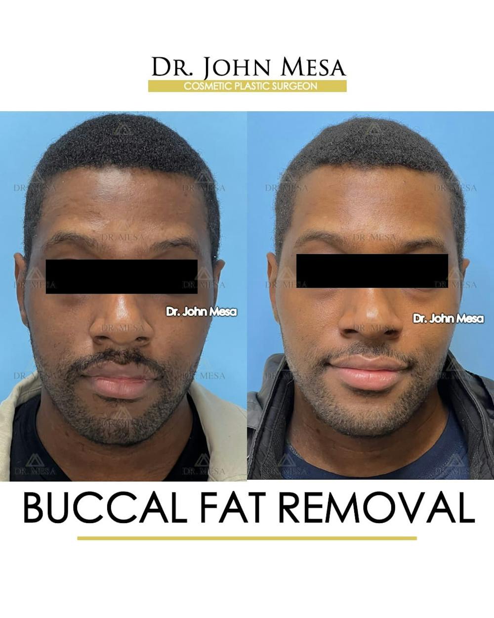 Patient 624194 | Buccal Fat Pad Removal for Men Before & After Photos ...