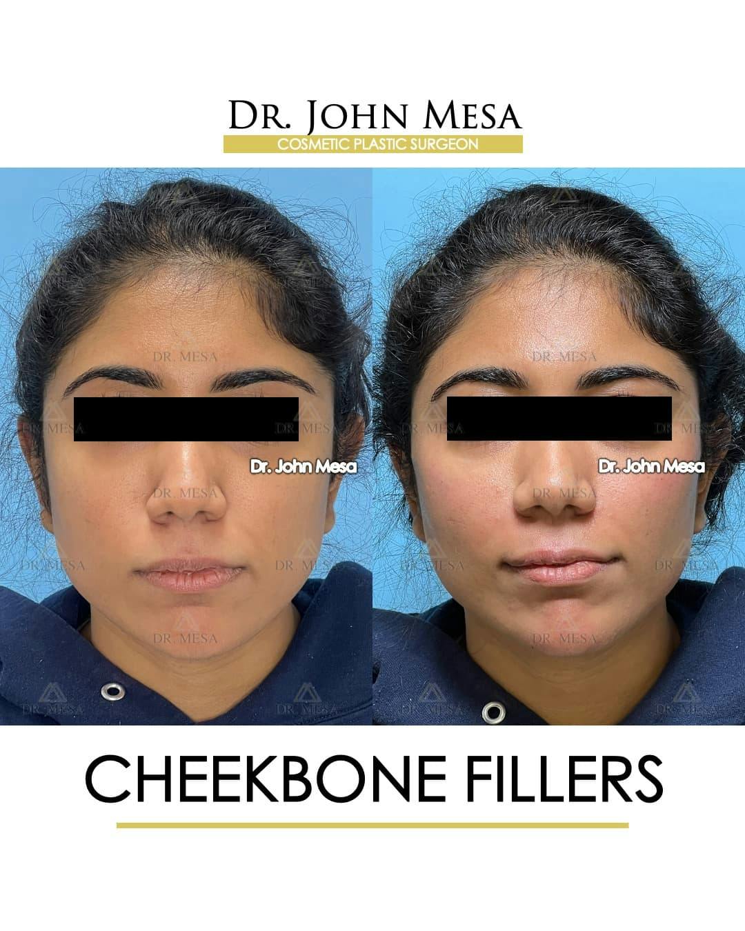 Cheekbone Filler Before & After Photos | Dr. Mesa