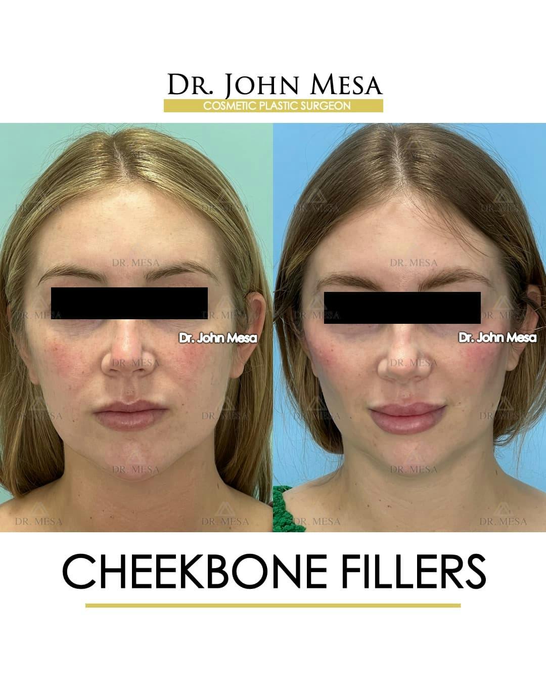 Cheekbone Filler Before & After Photos | Dr. Mesa