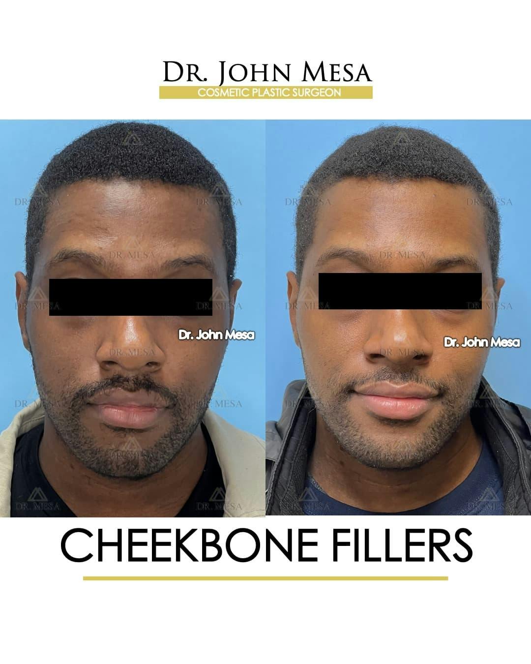 Cheekbone Filler for Men Before & After Photos | Dr. Mesa