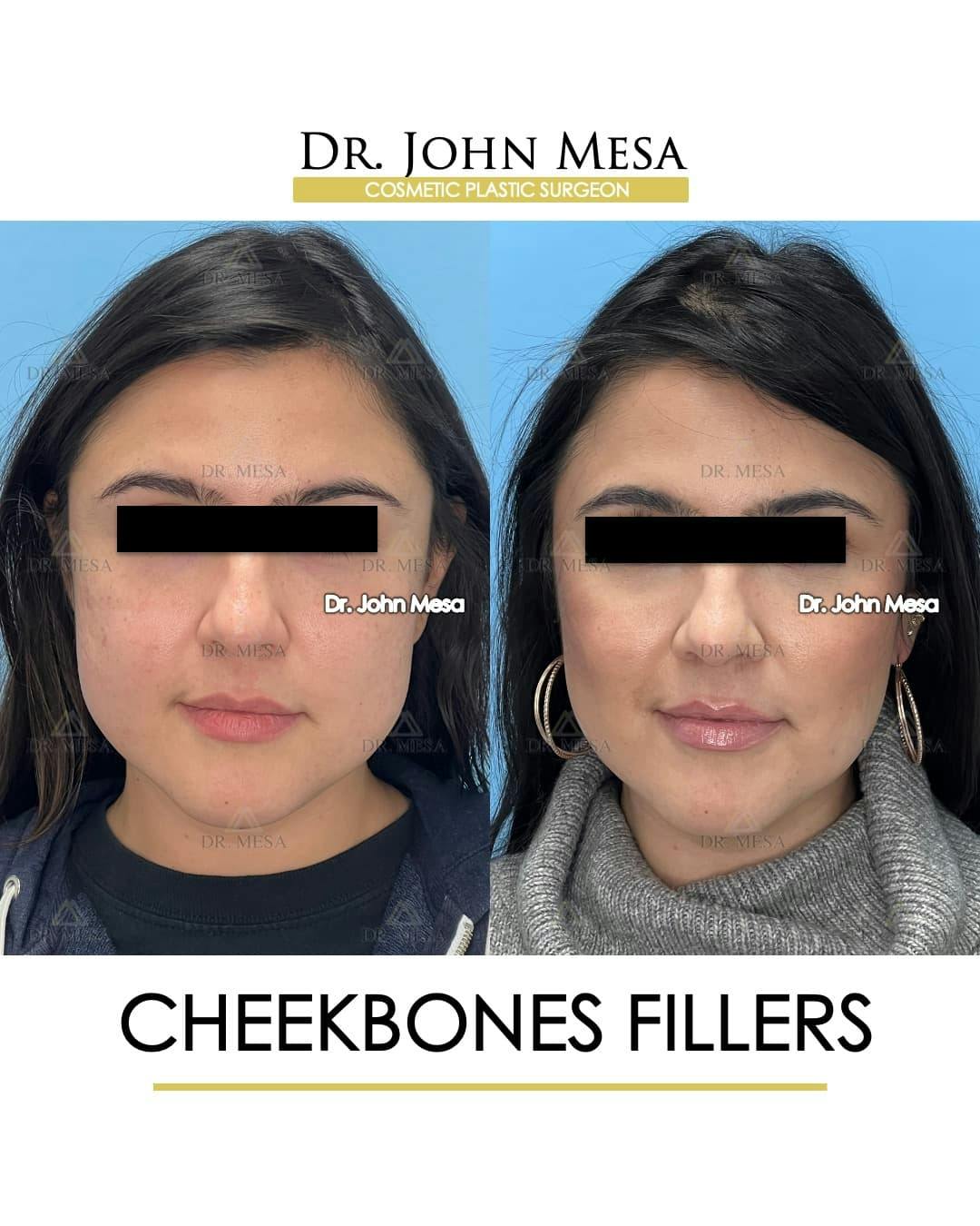 Cheekbone Filler Before & After Photos | Dr. Mesa