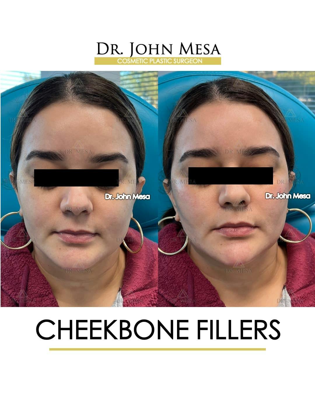 Cheekbone Filler Before & After Photos | Dr. Mesa
