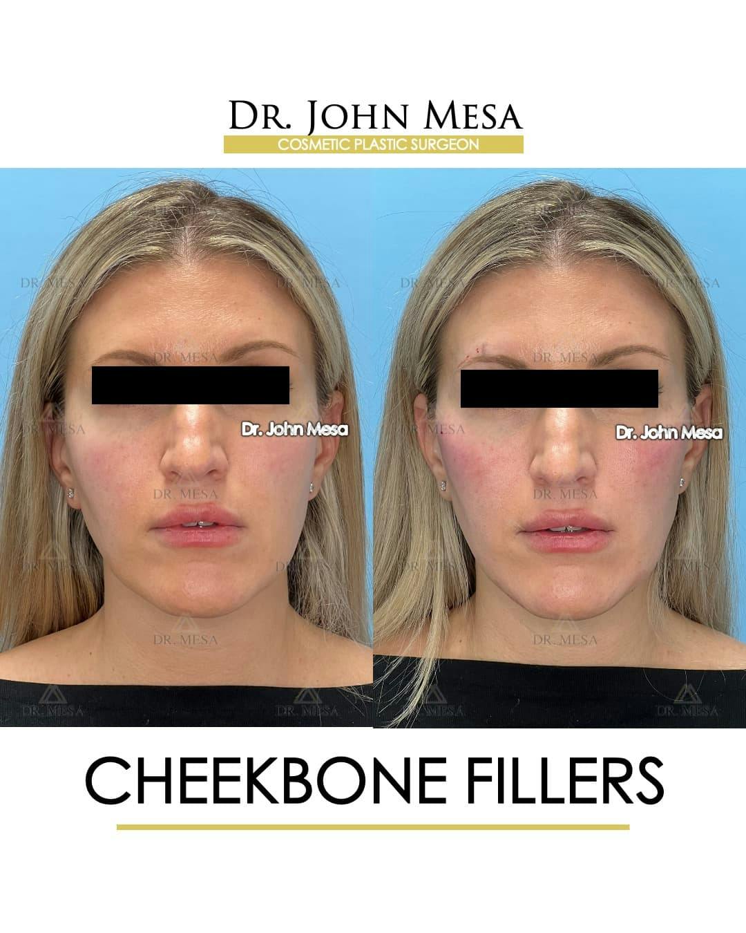 Cheekbone Filler Before & After Photos | Dr. Mesa
