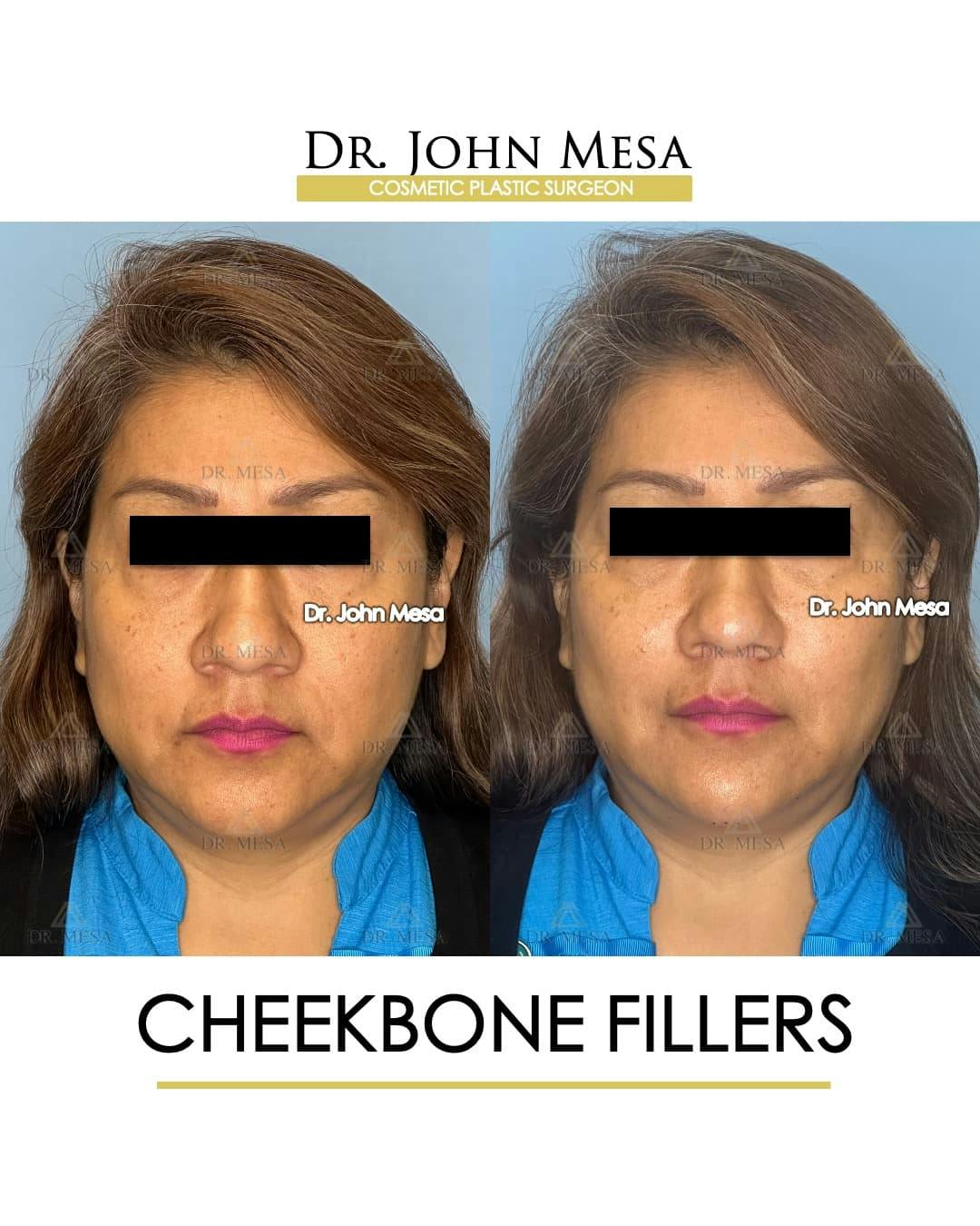 Cheekbone Filler Before & After Photos | Dr. Mesa