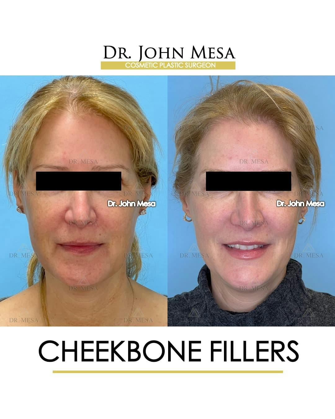 Cheekbone Filler Before & After Photos | Dr. Mesa