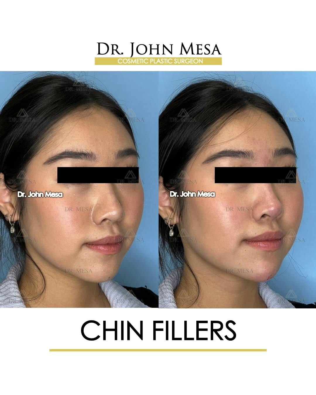 Chin Filler Before & After Photos | Dr. Mesa