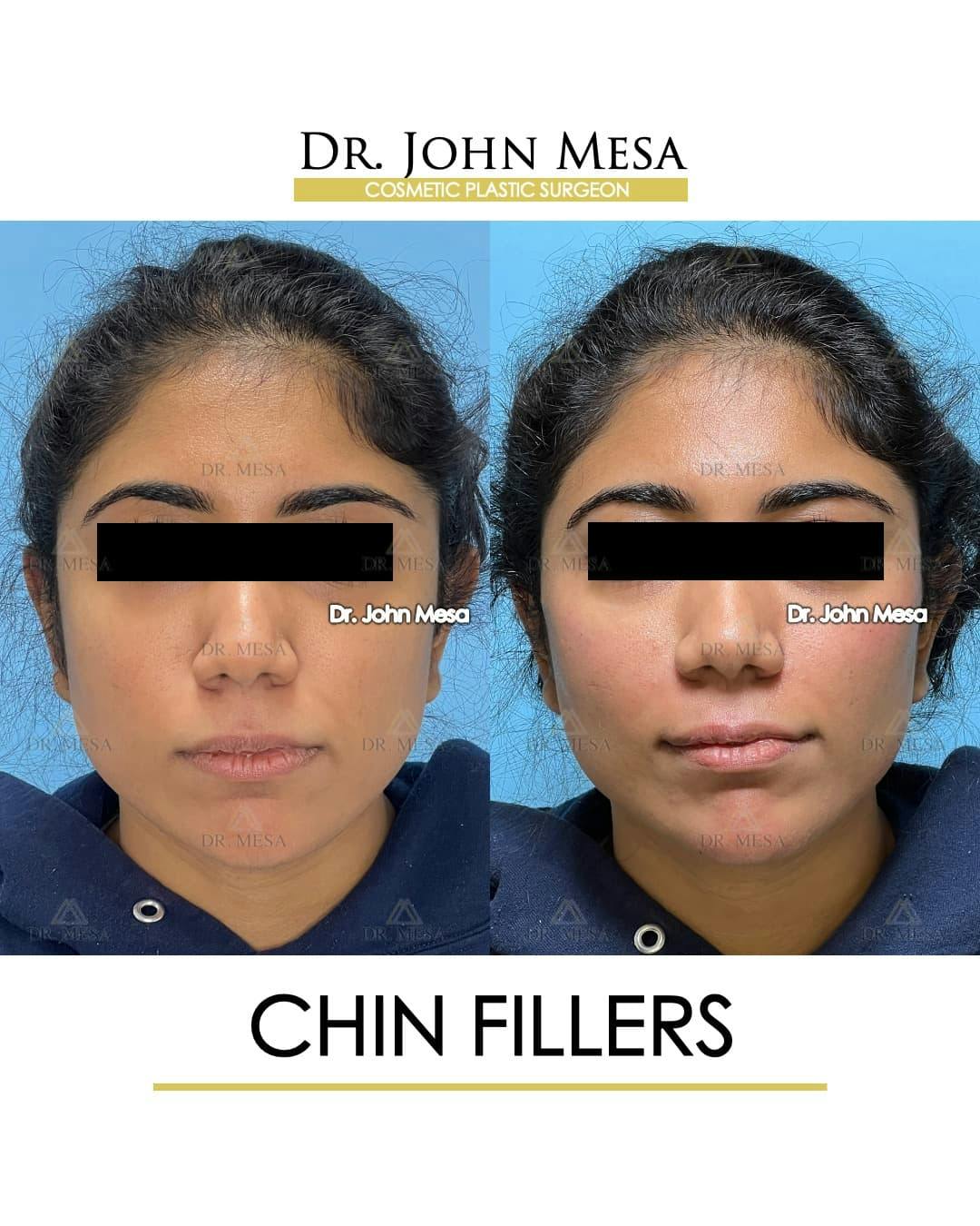 Chin Filler Before & After Photos | Dr. Mesa