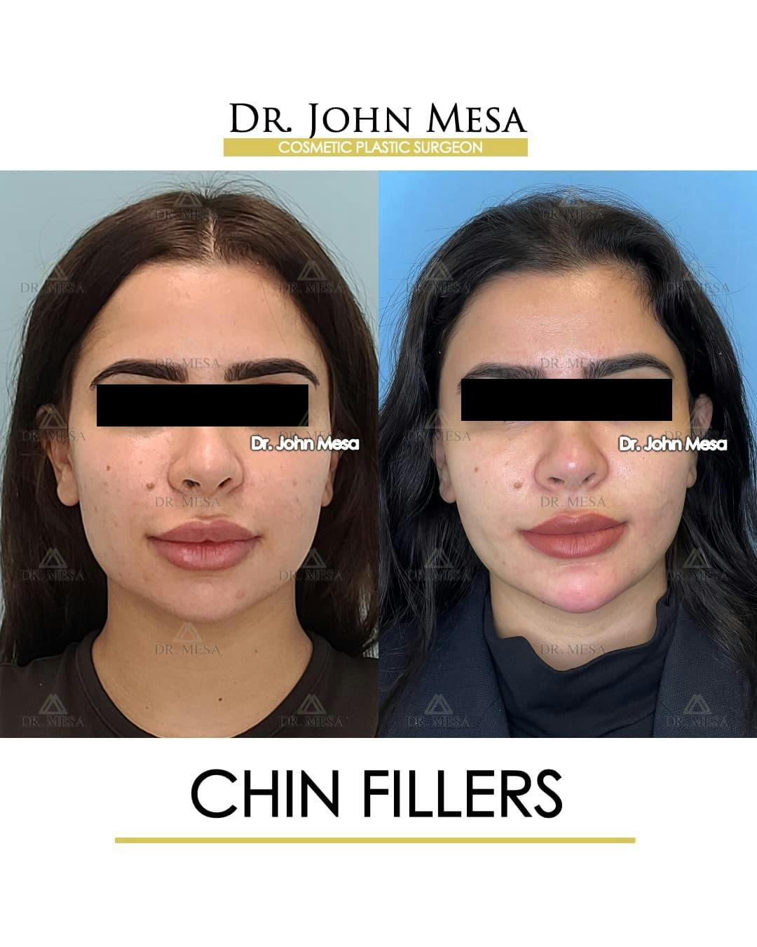 Chin Filler Before & After Photos | Dr. Mesa