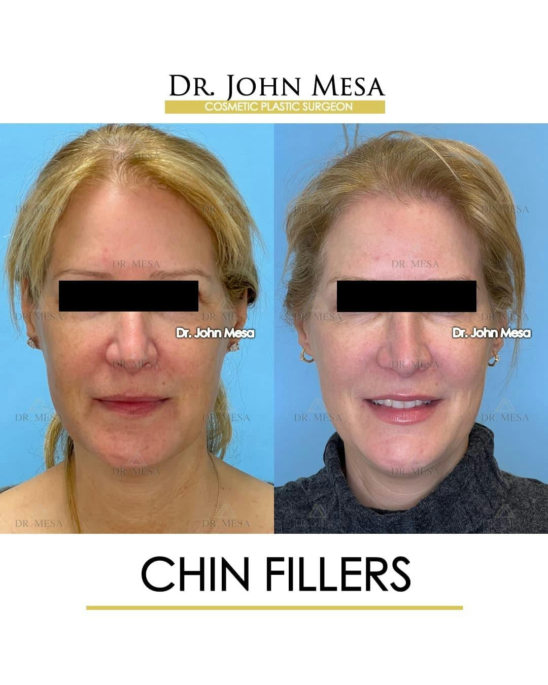 Chin Filler Before & After Photos | Dr. Mesa