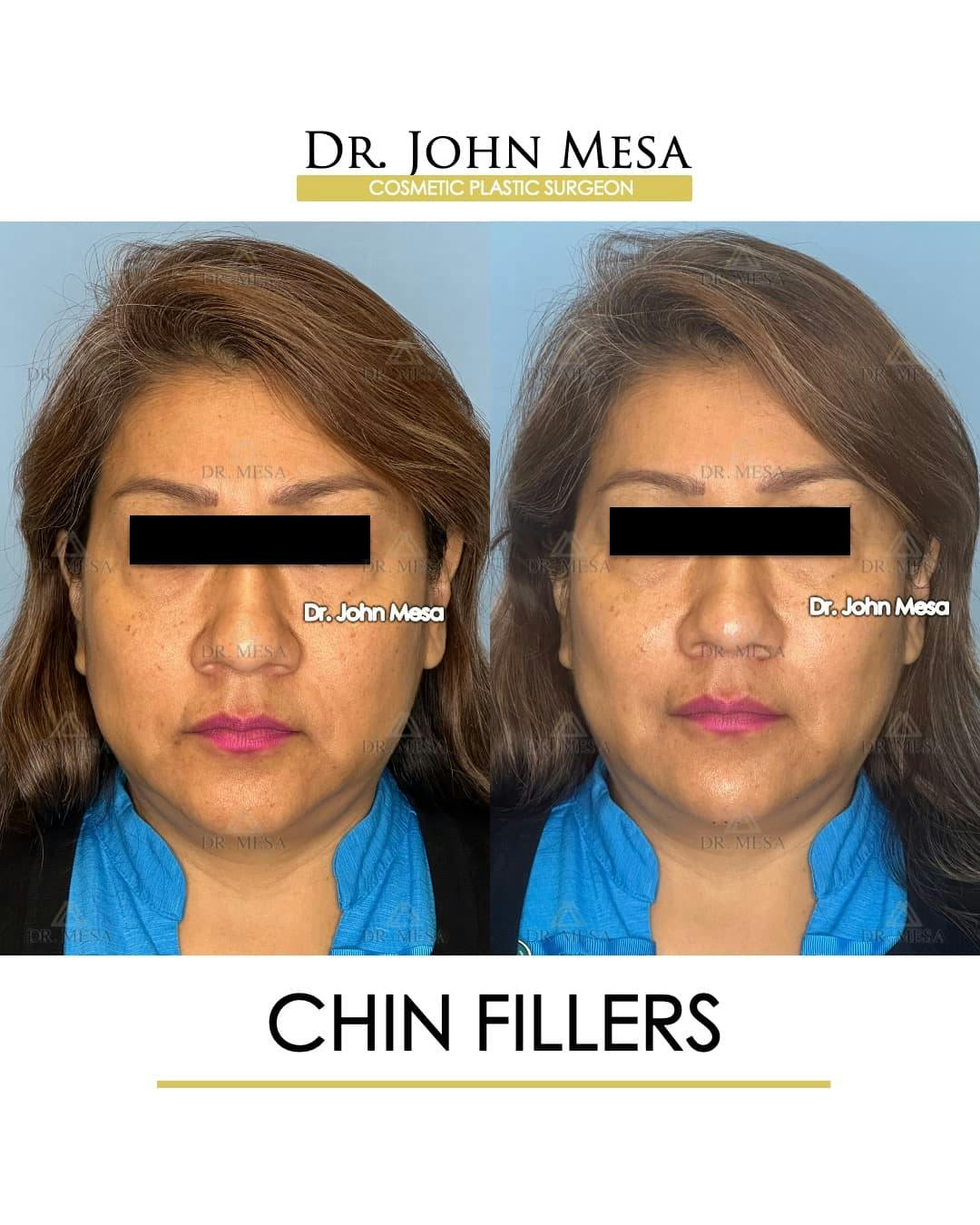 Chin Filler Before & After Photos | Dr. Mesa