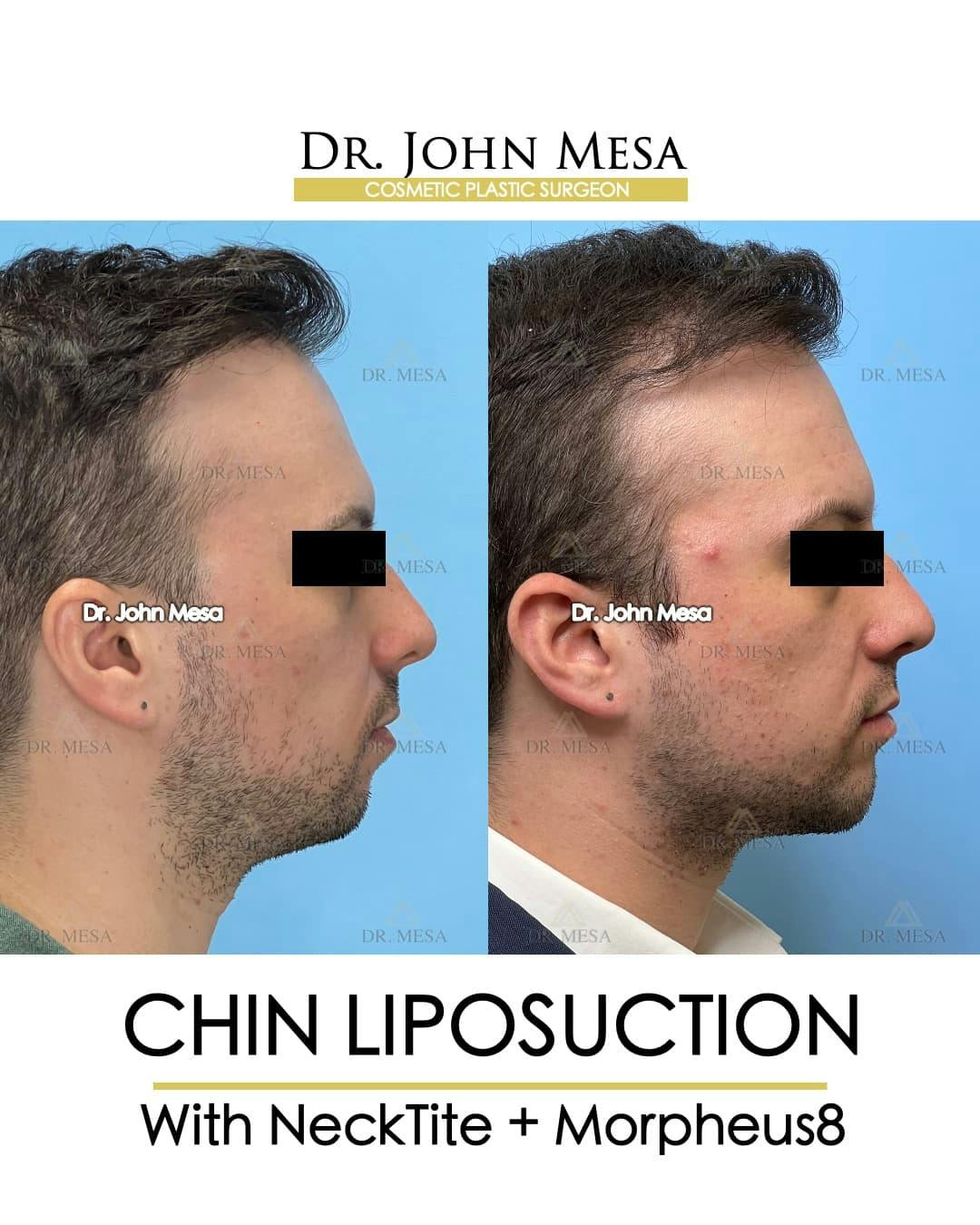 Chin Liposuction for Men Before & After Photos | Dr. Mesa