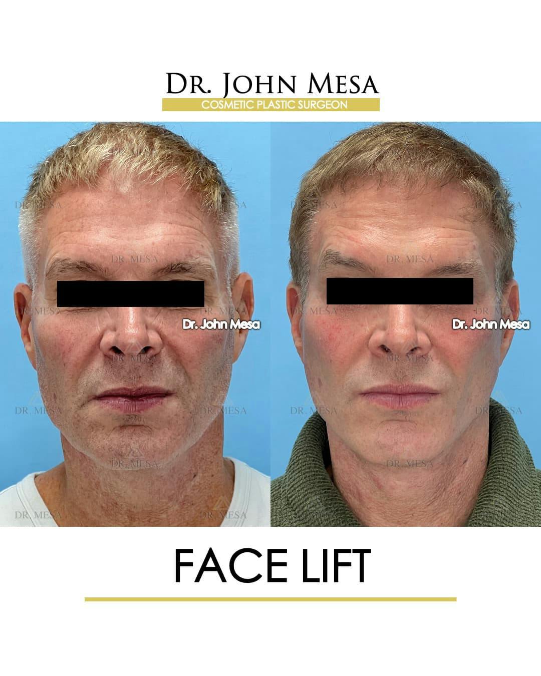 Facelift for Men Before & After Photos | Dr. Mesa
