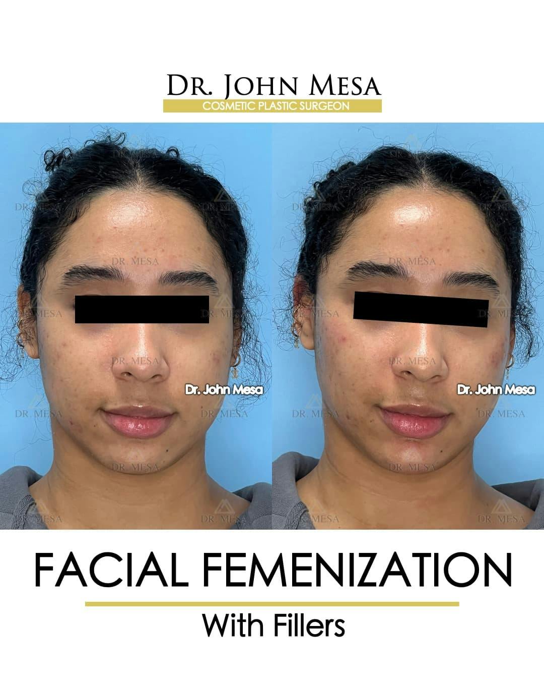 Facial Feminization Before & After Photos | Dr. Mesa