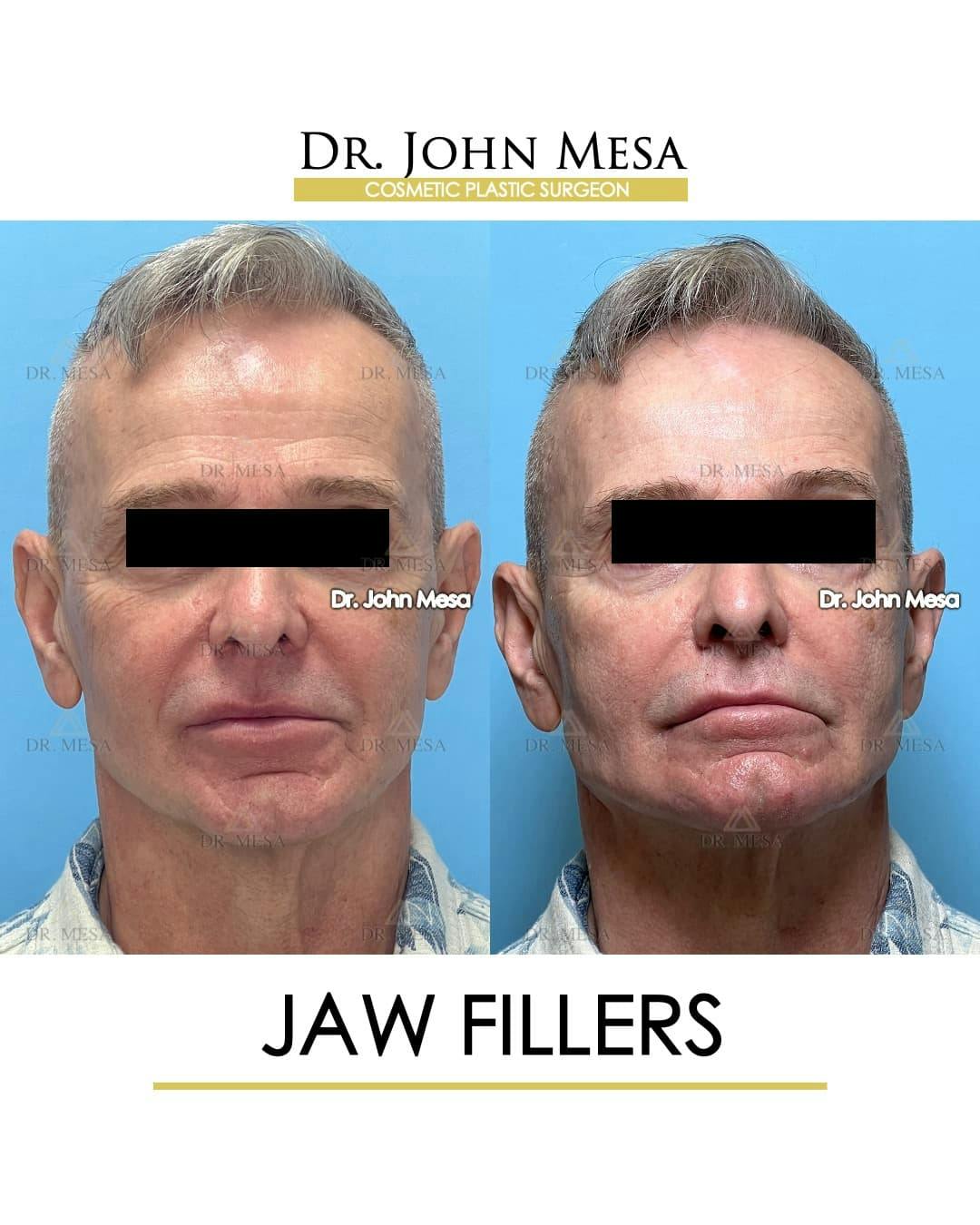 Jaw Filler for Men Before & After Photos | Dr. Mesa
